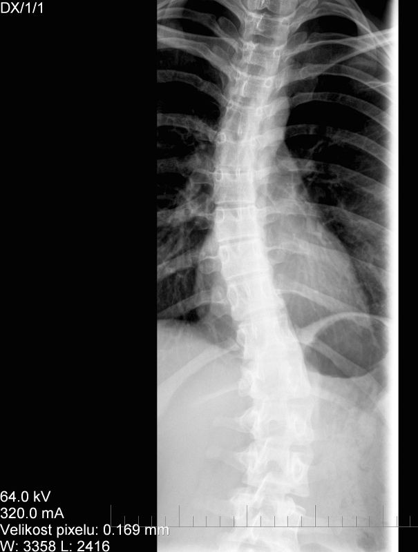 Scintigrafie skeletu - kdy a jak se provádí vyšetření kostí | uLékaře.cz