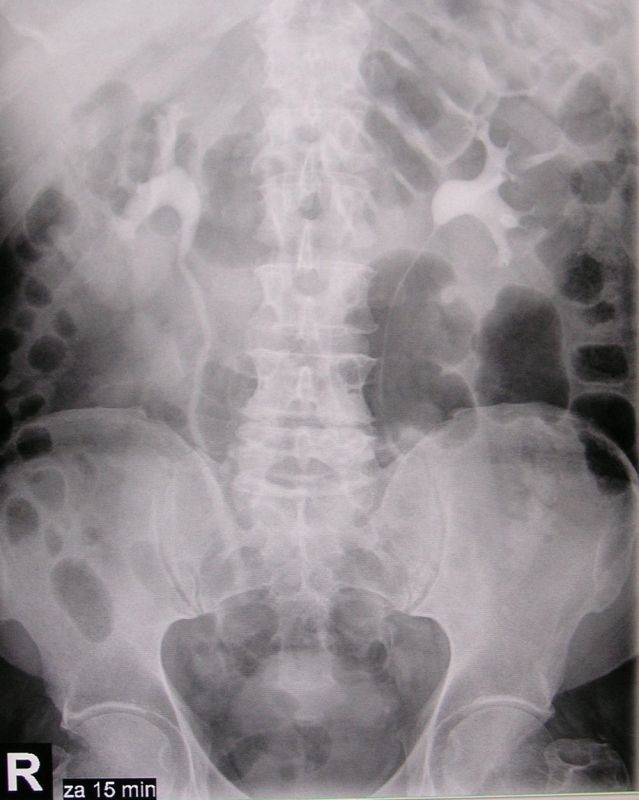 Vylučovací urografie | uLékaře.cz